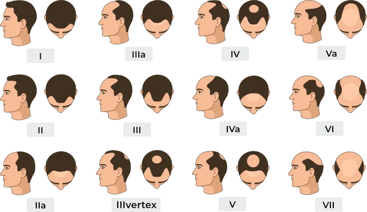 Norwood Scale | Stages of Male Pattern Baldness Explained