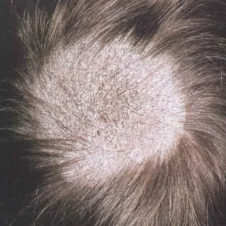 Tinea Capitis | Causes, Symptoms & Treatments
