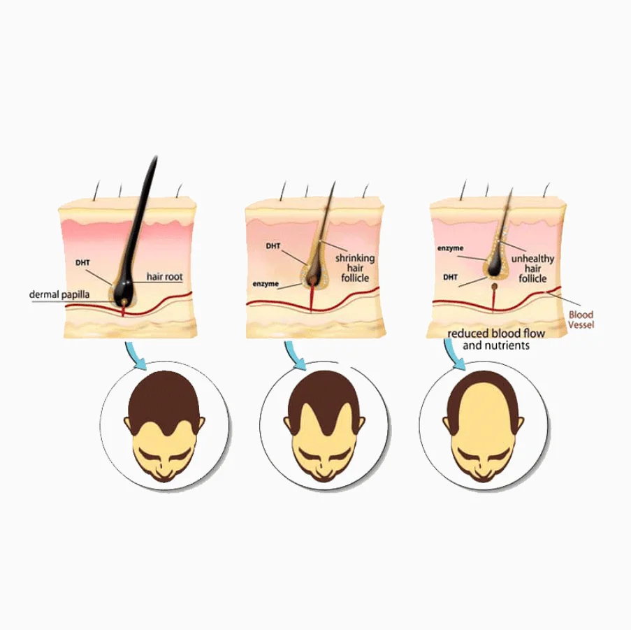 The Role of Blood Flow in Hair Loss