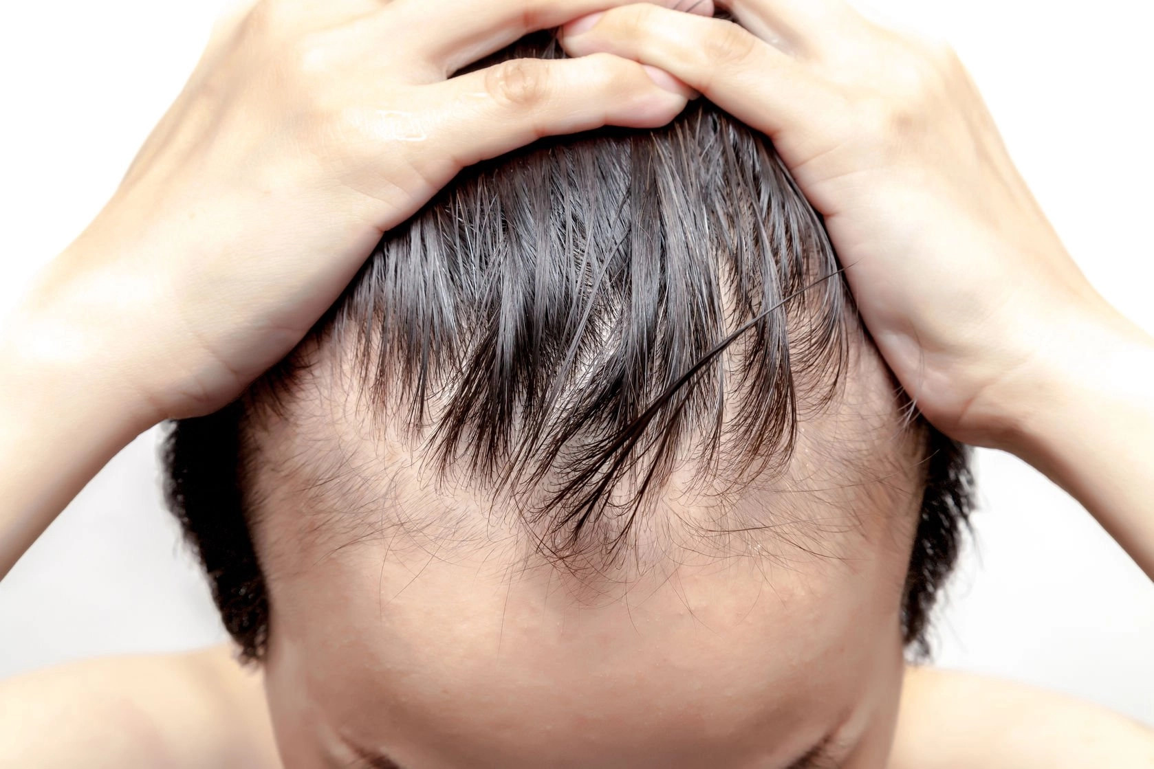 The Symptoms of Male Pattern Baldness (MPB)