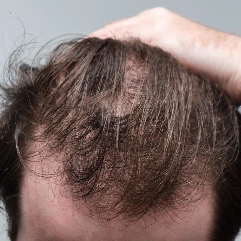 Why The Hair Shedding Phase is Positive